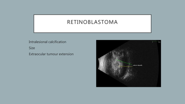 B scan ultrasonography | PPTX