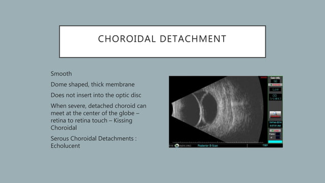 B scan ultrasonography | PPTX