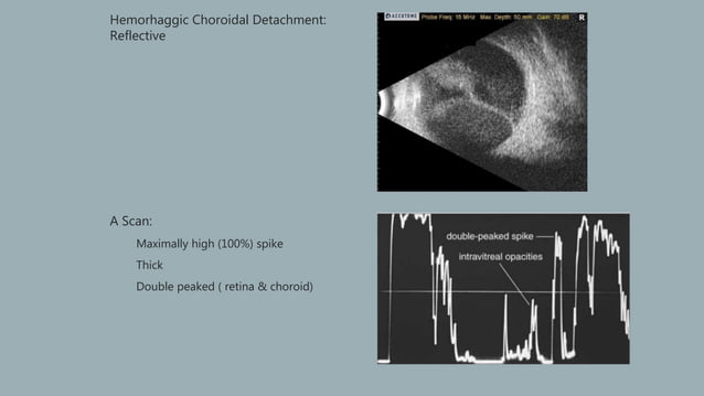 B scan ultrasonography | PPTX