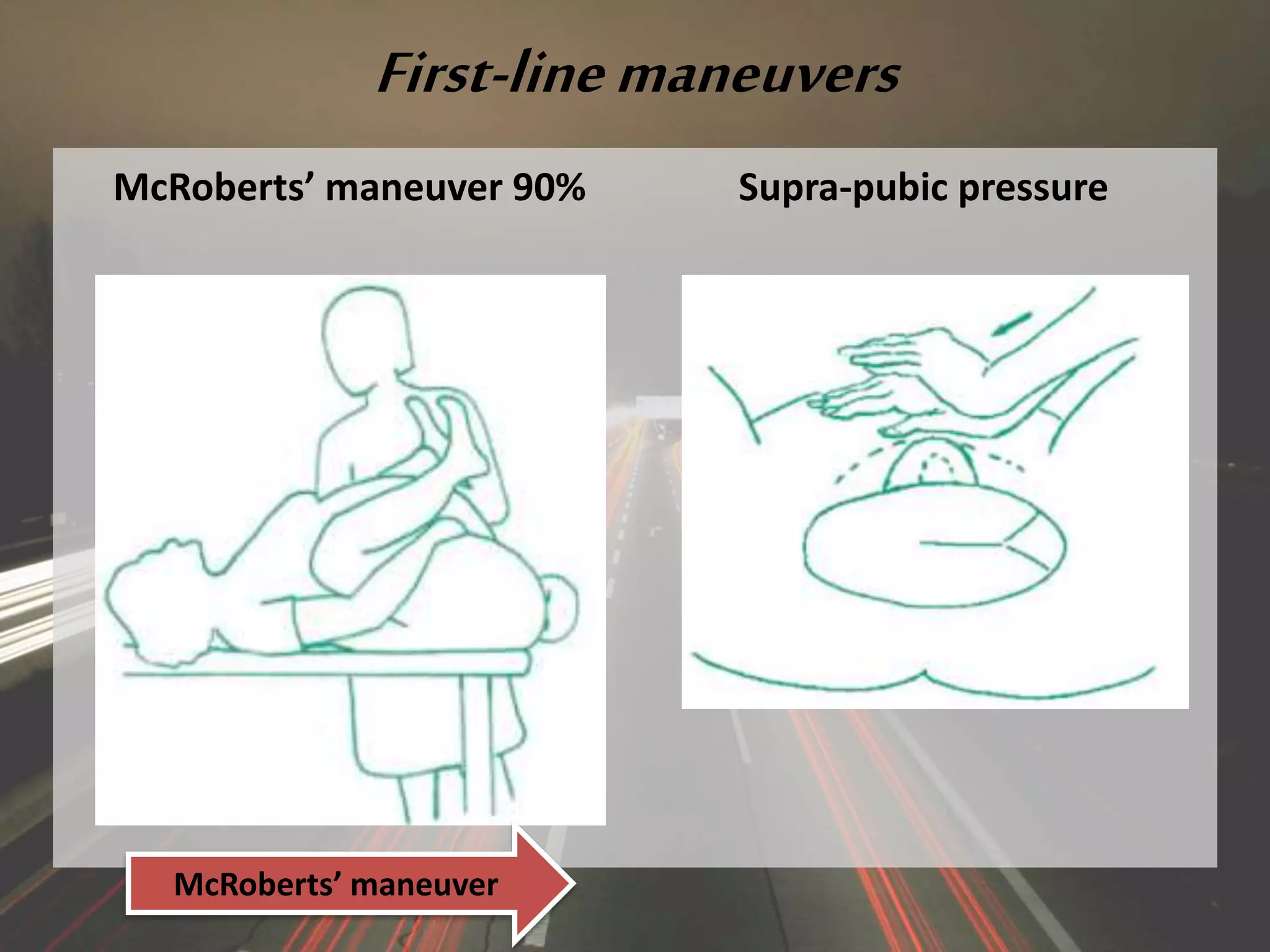 Shoulder dystocia | PPTX