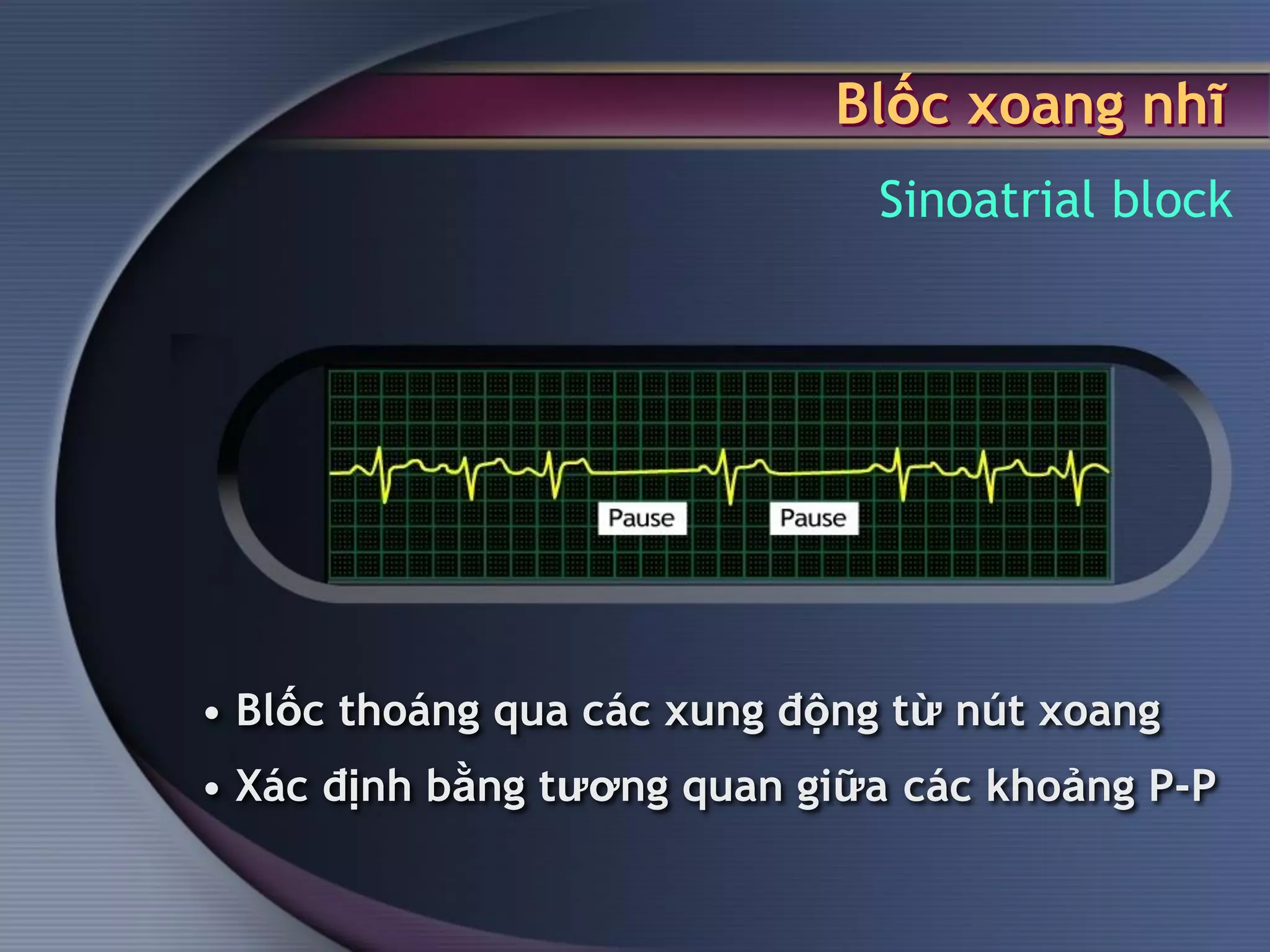 ĐIỆN TÂM ĐỒ TRONG RỐI LOẠN NHỊP TIM CHẬM | PDF