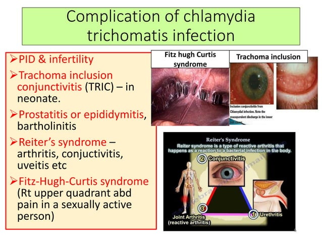 Clinical microbiology : Chlamydia trachomatis an overview of STD's Clinical microbiology : Chlamydia trachomatis an overview of STD's