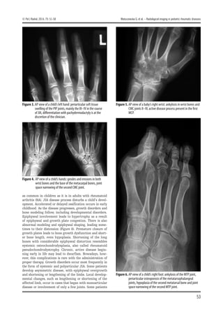 poljradiol-79-51 | PDF | Bone and Joint Conditions | Diseases and ...