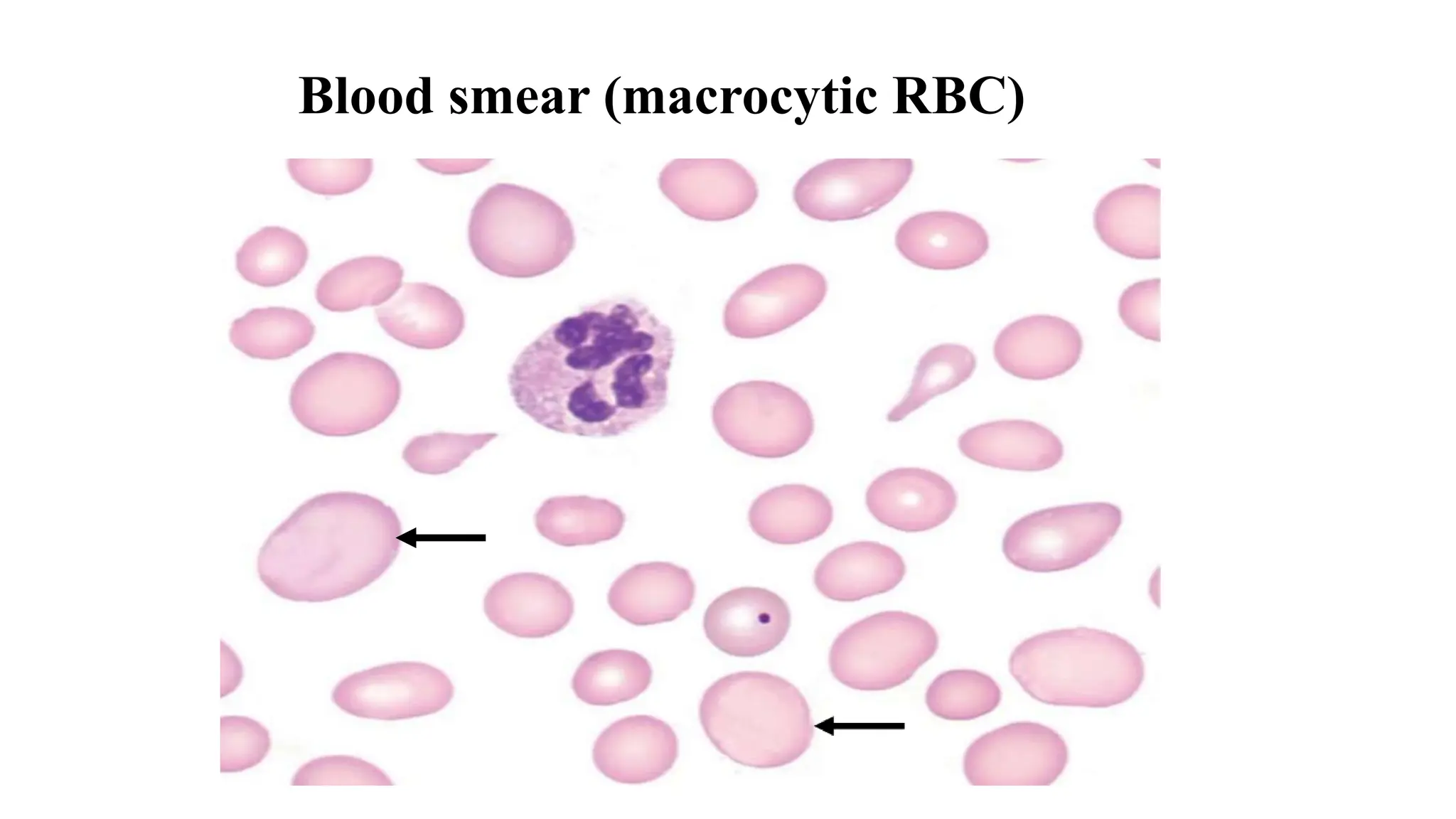 B12—-an———-Folate-deficiency-Anemia.pptx
