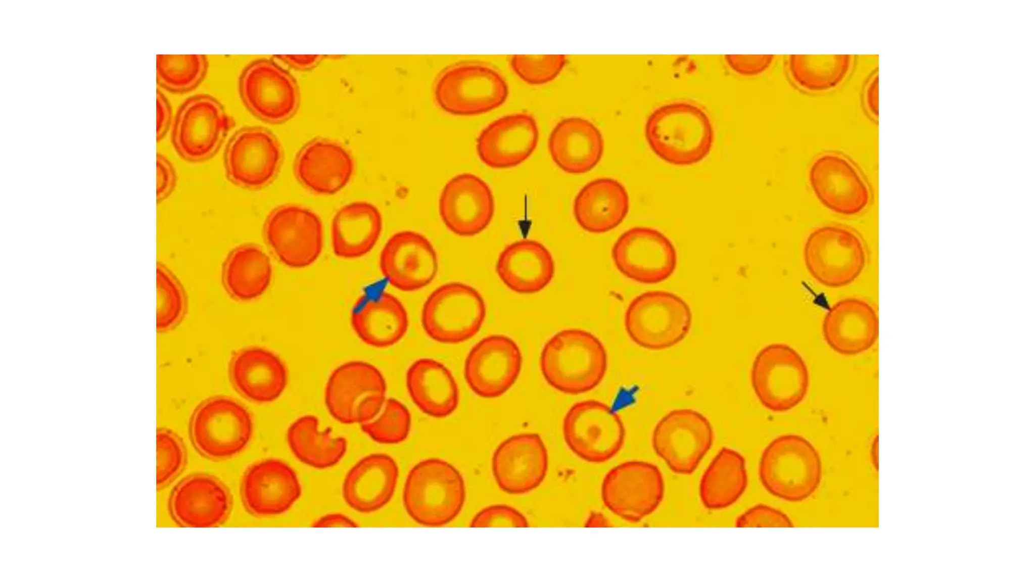 B12—-an———-Folate-deficiency-Anemia.pptx