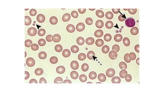 B12—-an———-Folate-deficiency-Anemia.pptx