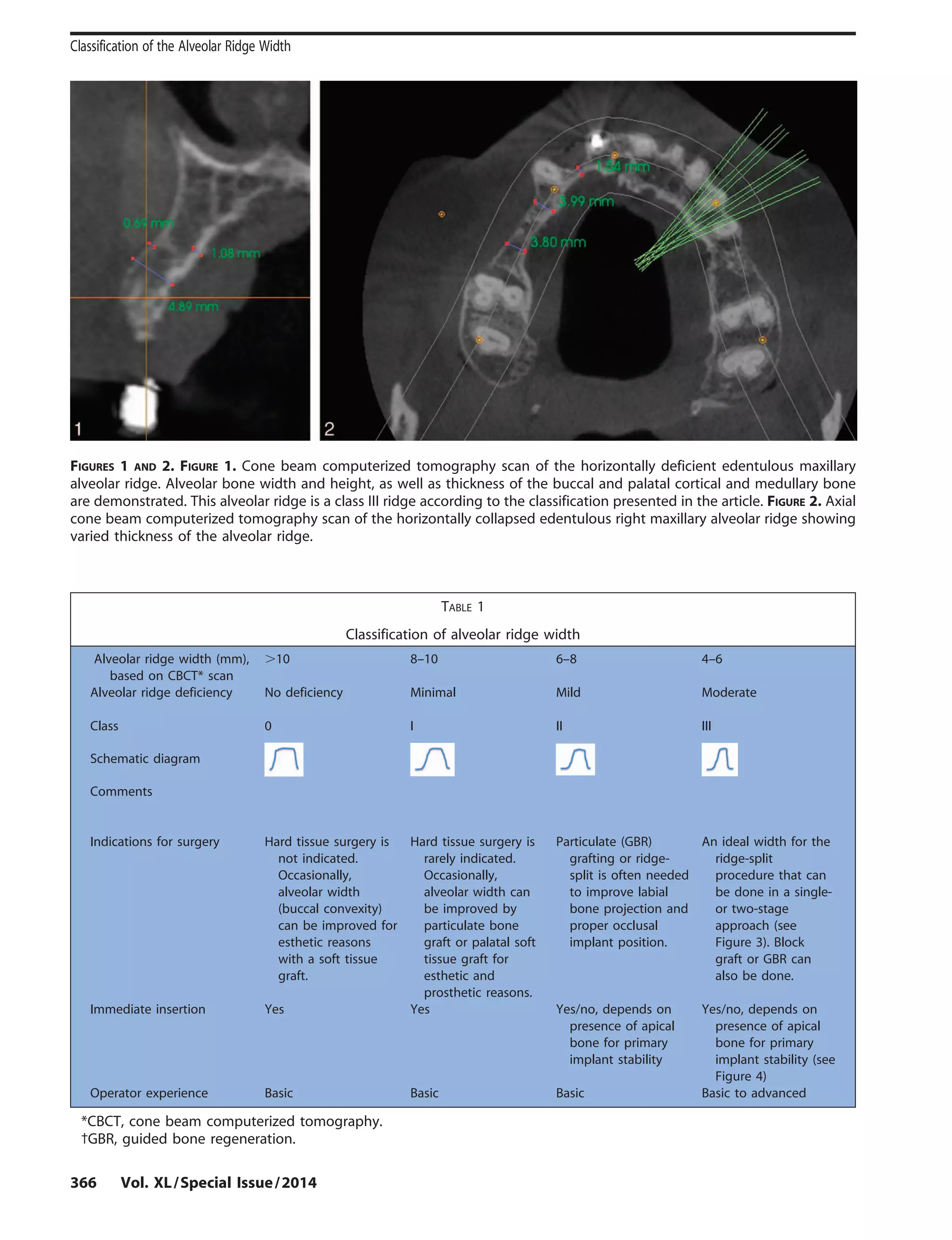 Classification of alveolar bone width | PDF