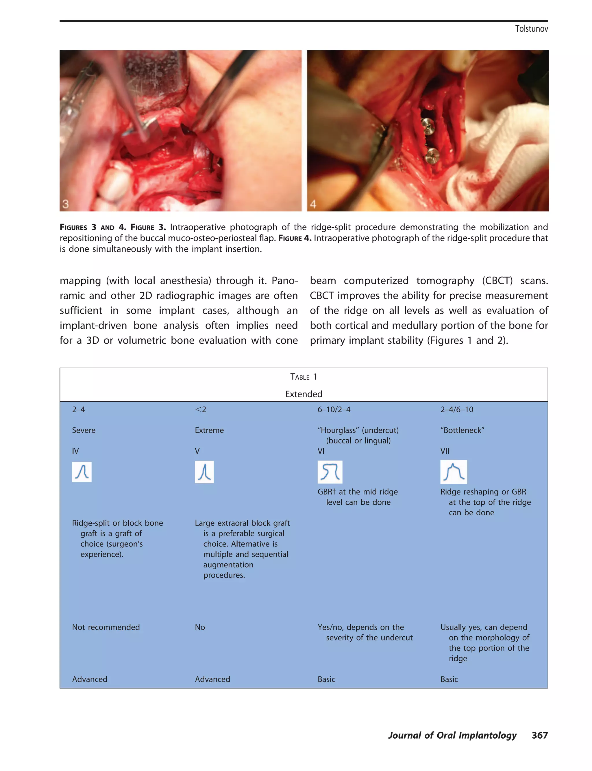 Classification of alveolar bone width | PDF