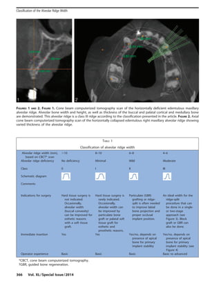 Classification of alveolar bone width | PDF | Bone and Joint Conditions ...