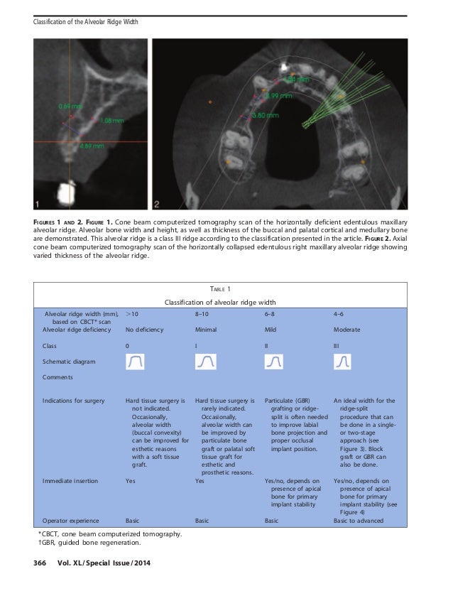 Edentulous alveolar ridge denture classification - hanbda