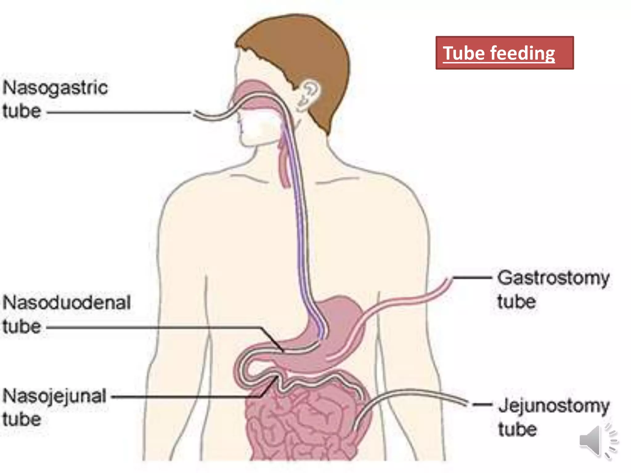 Percutaneous Endoscopic Gastrostomy | PPTX
