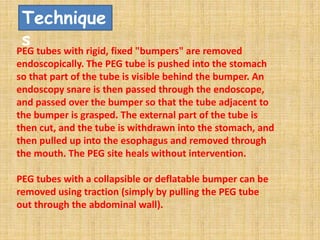 Percutaneous Endoscopic Gastrostomy | PPTX