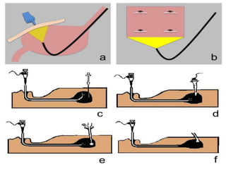 Percutaneous Endoscopic Gastrostomy | PPTX