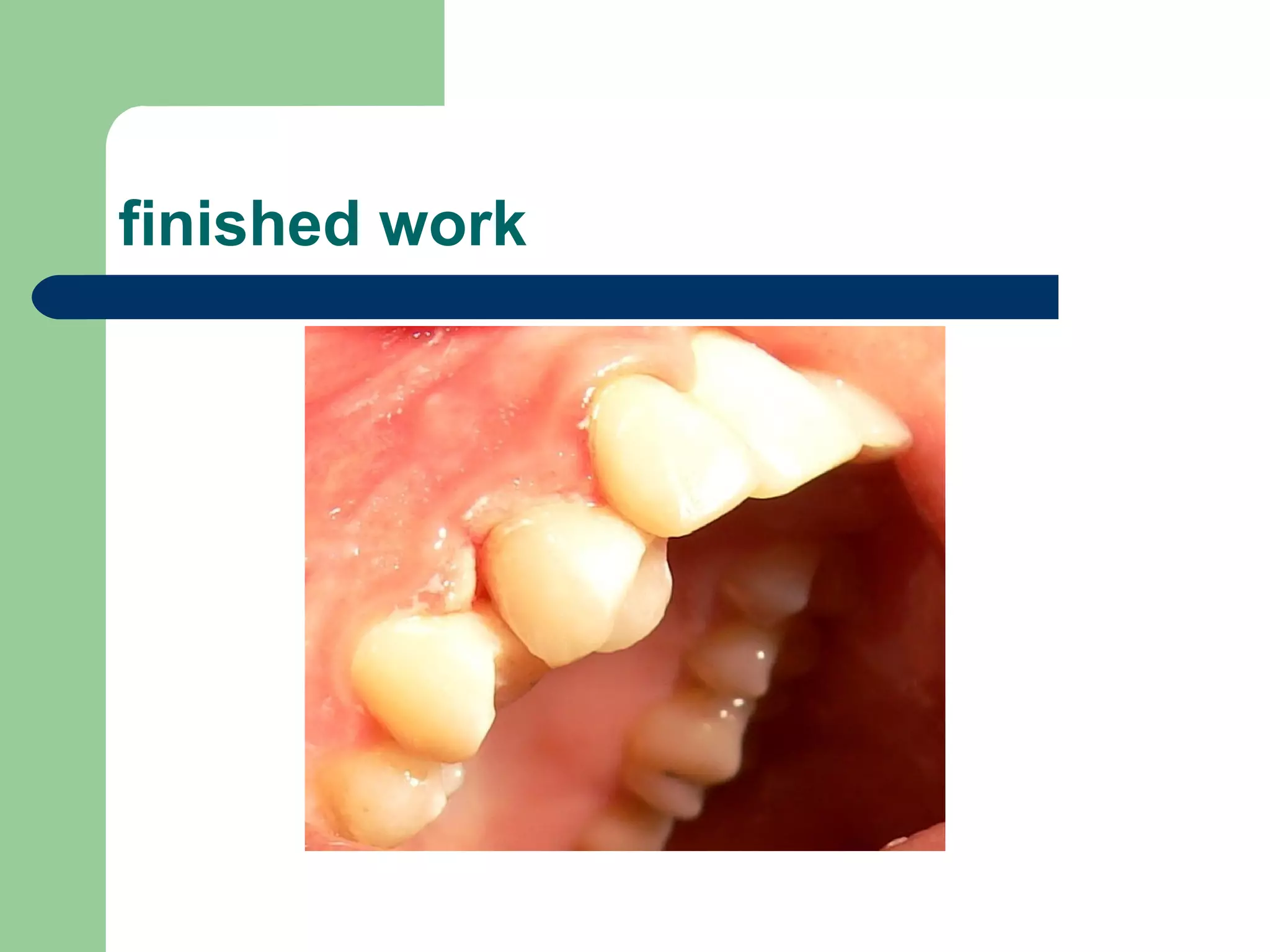 reconstruction of oral inclination of teeth 13, | PPT