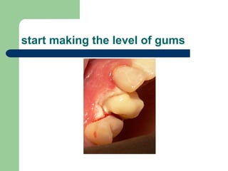 reconstruction of oral inclination of teeth 13, | PPT