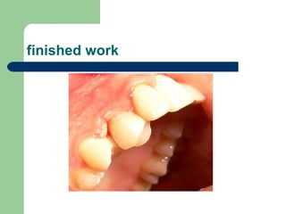 reconstruction of oral inclination of teeth 13, | PPT