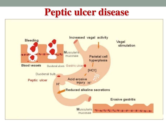 B1 git med1 peptic ulcer disease