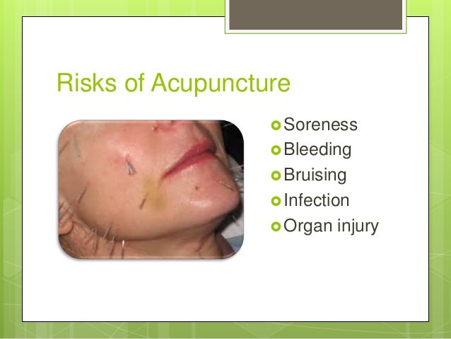 Acupuncture Presentation