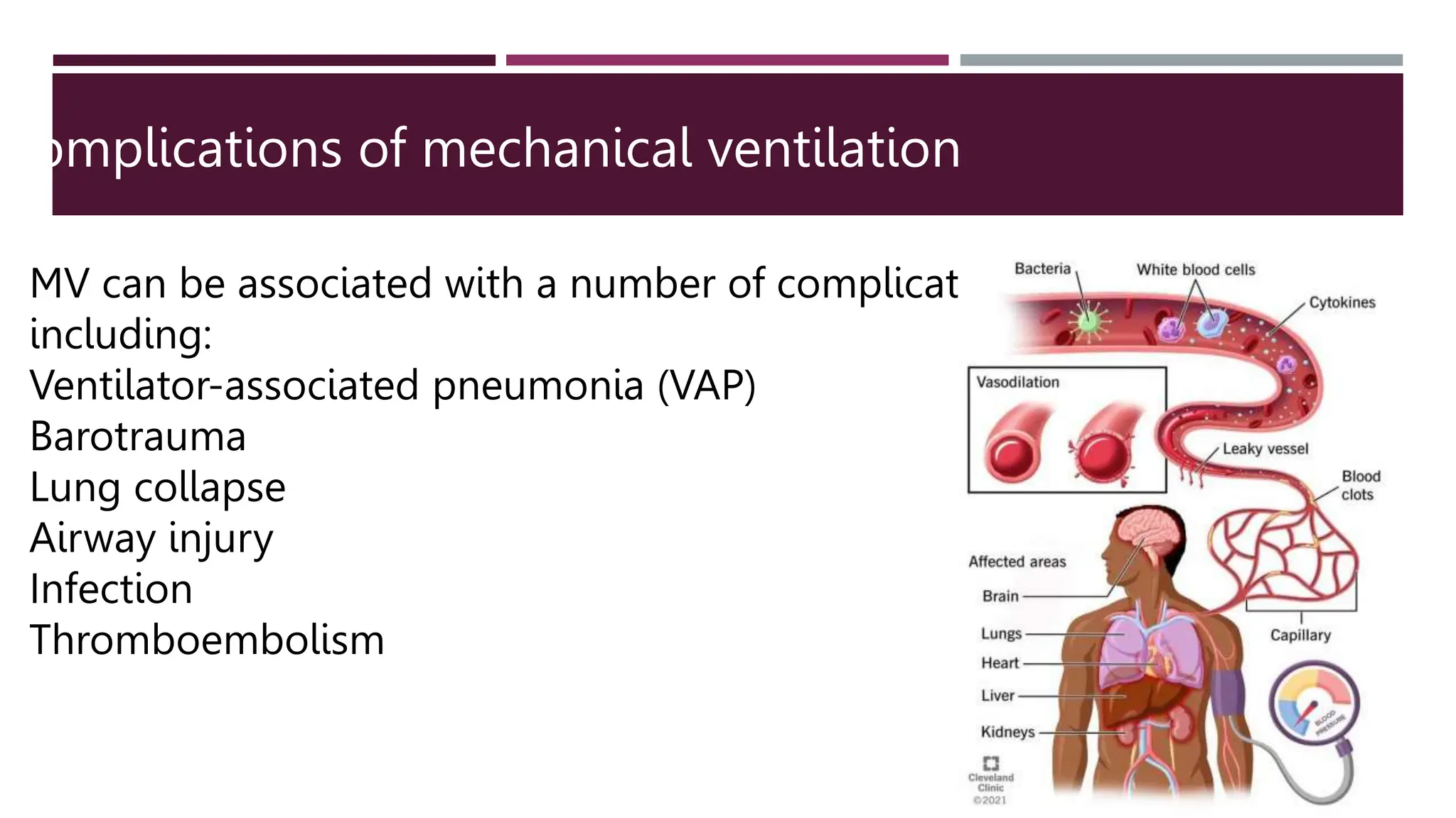mechanical ventilator | PPTX