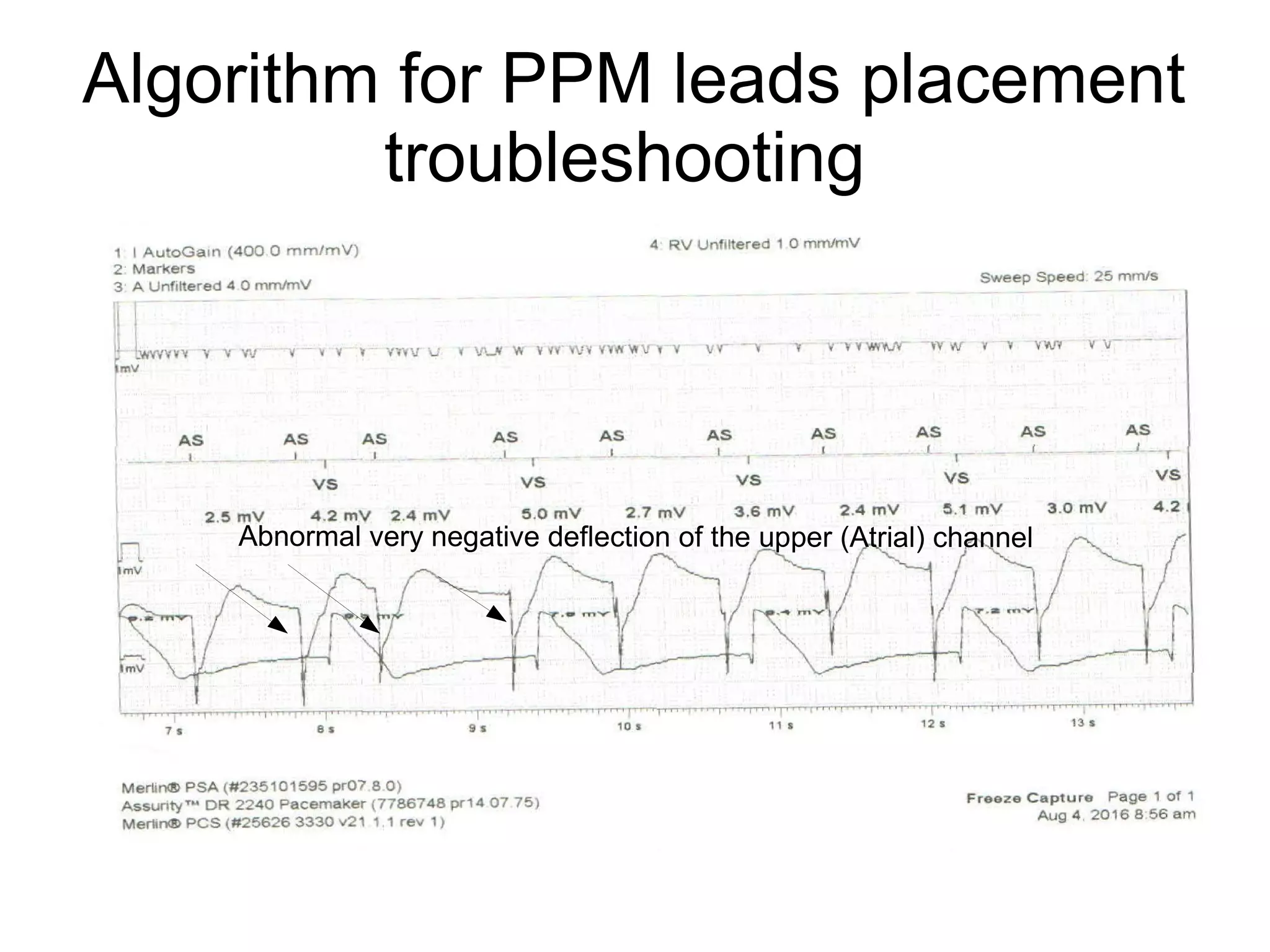 PPM RA lead troubleshooting | PPT