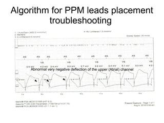PPM RA lead troubleshooting | PPT