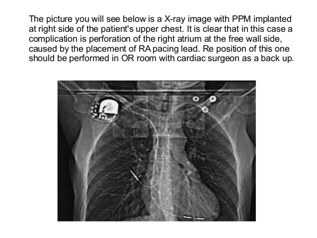 PPM RA lead troubleshooting