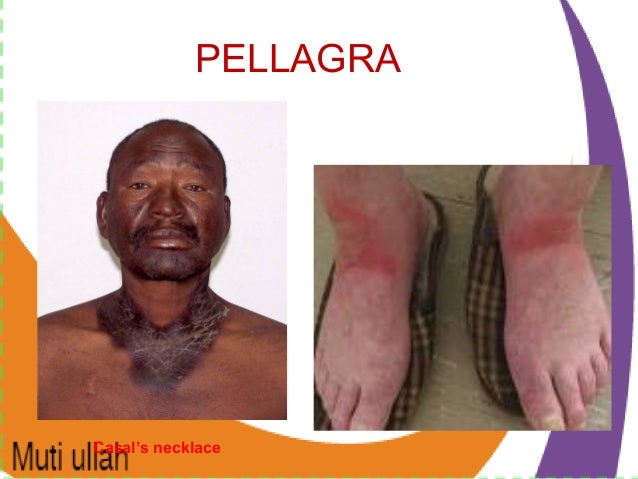 Vitamin B3,b5 and b6 ,the pallagra preventive factors