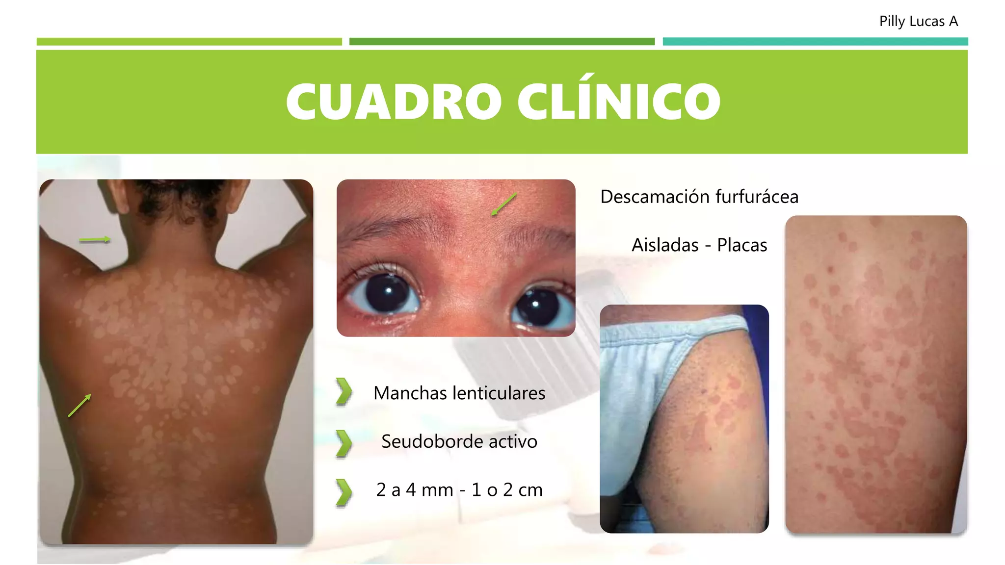 Pitiriasis versicolor. Dermatología | PPTX