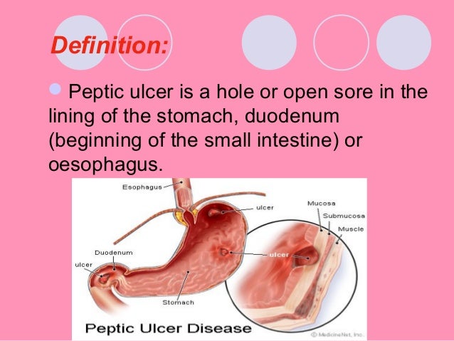 peptic ulcer disease.PPT
