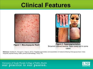 Chikungunya PPT_RP | PDF