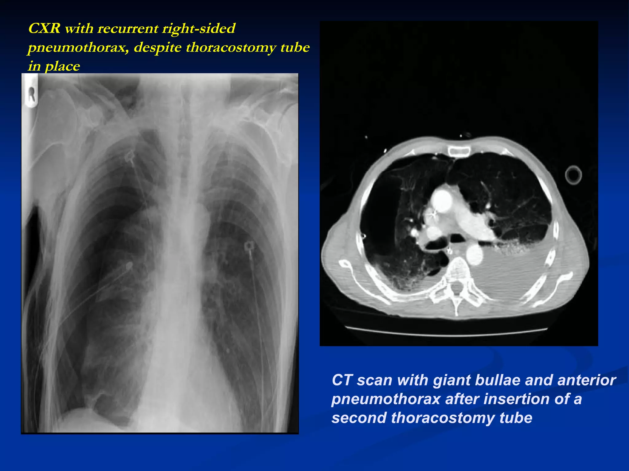 pneumothorax in ICU | PPT