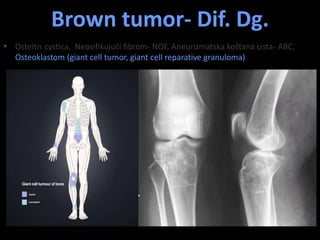 Brown tumor- LIn | PPTX