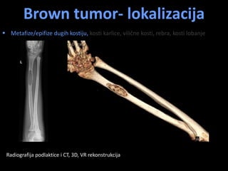 Brown tumor- LIn | PPTX