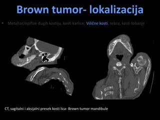 Brown tumor- LIn | PPTX