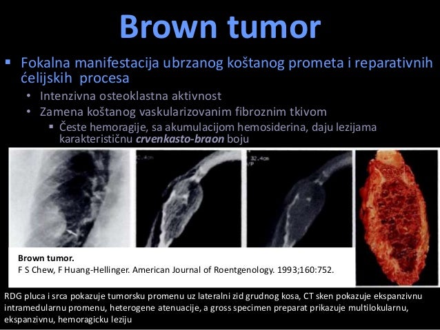 Brown tumor- LIn