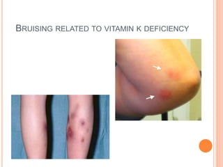 Hepatitis C Case Study | PPTX