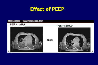 03_Acute_Lung_Injury_and_ARDS_dr._divatia.ppt