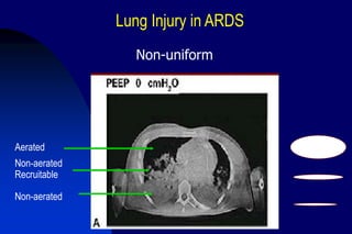03_Acute_Lung_Injury_and_ARDS_dr._divatia.ppt