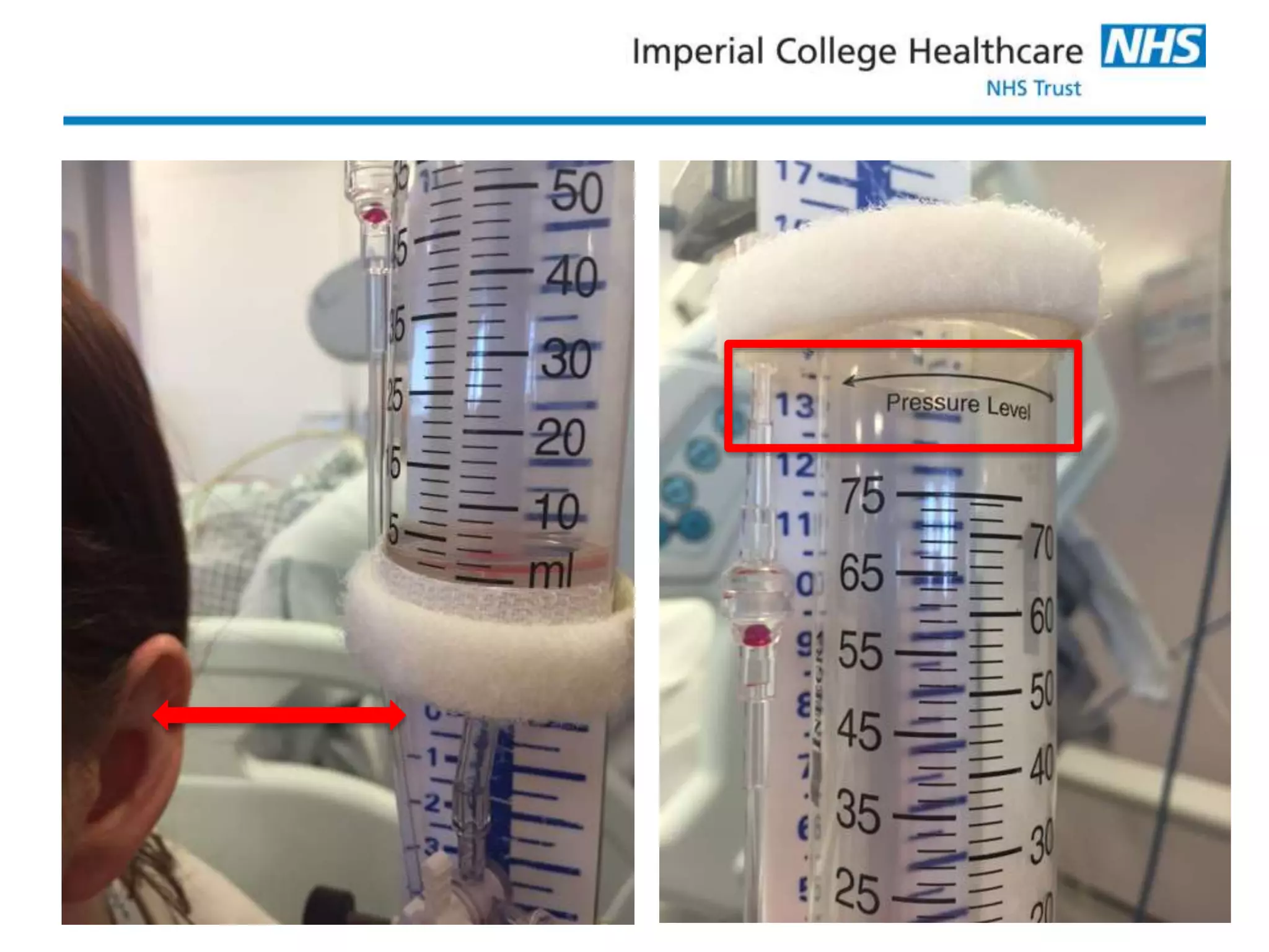 Spinal drain post-op management 2 | PPTX | Brain and Nervous System ...