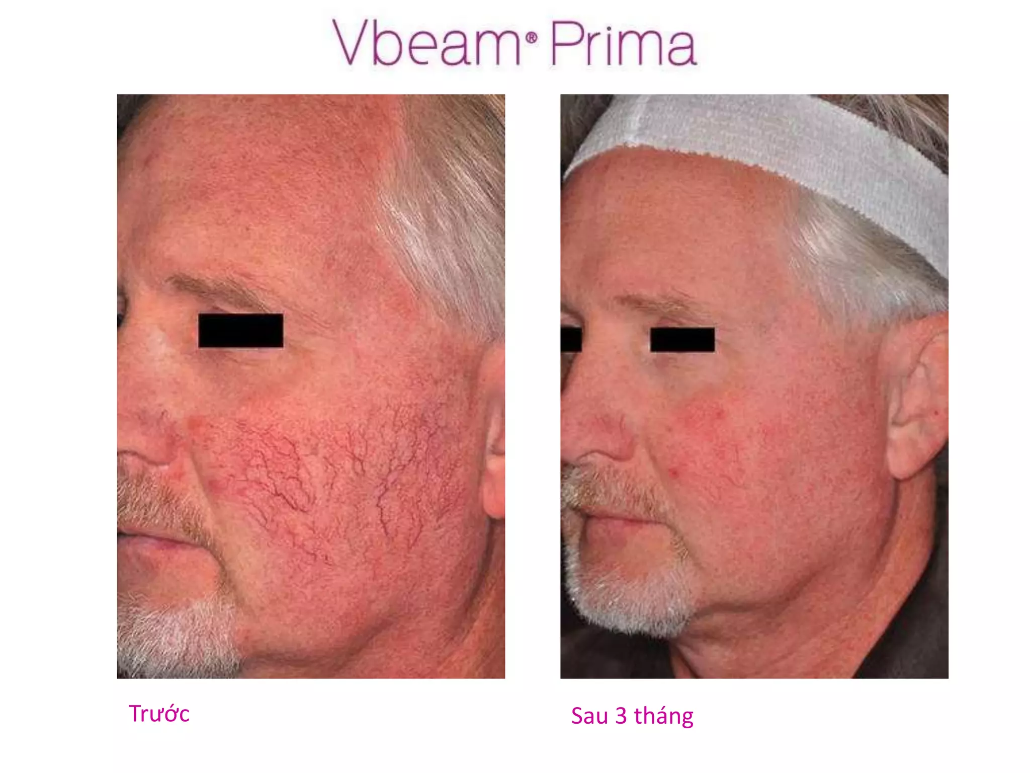 VBeam Prima NEW! Before and After treatment | PPTX
