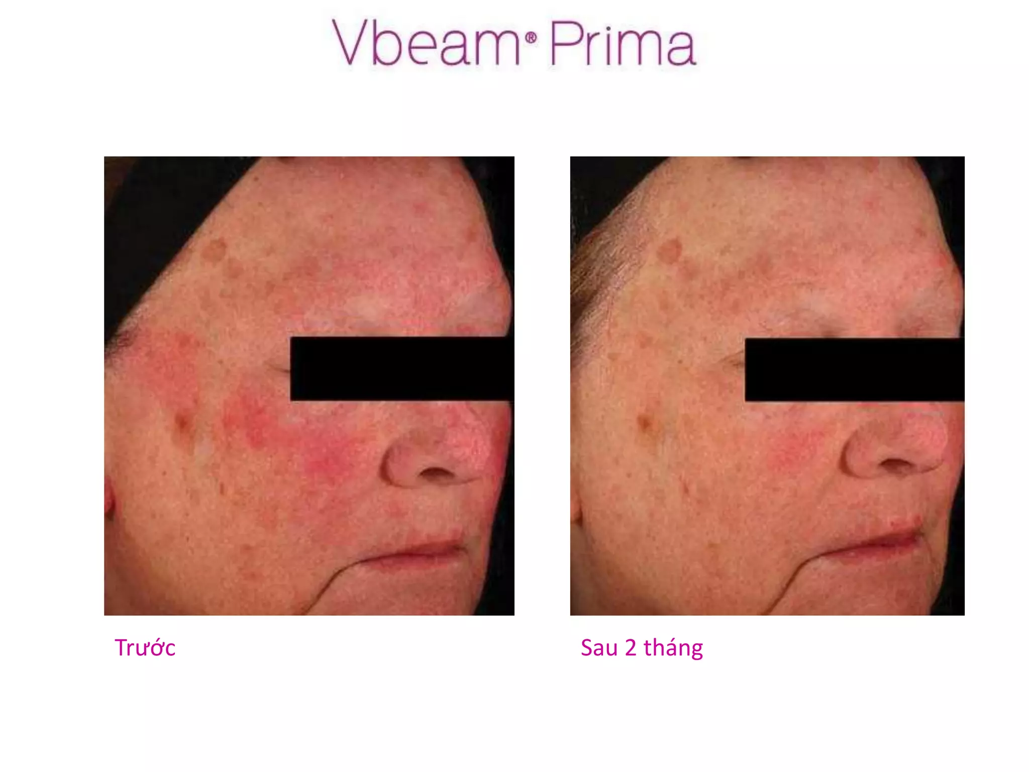 VBeam Prima NEW! Before and After treatment | PPTX