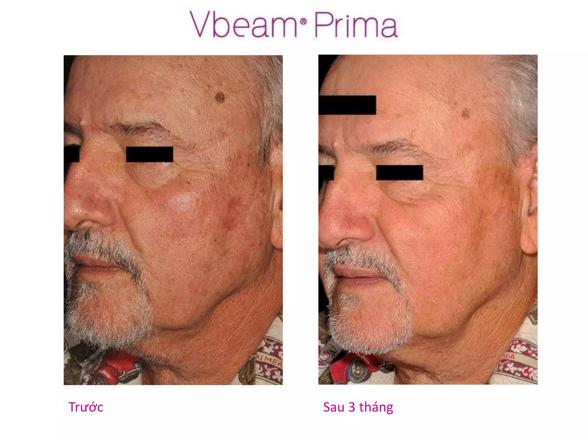 VBeam Prima NEW! Before and After treatment | PPTX