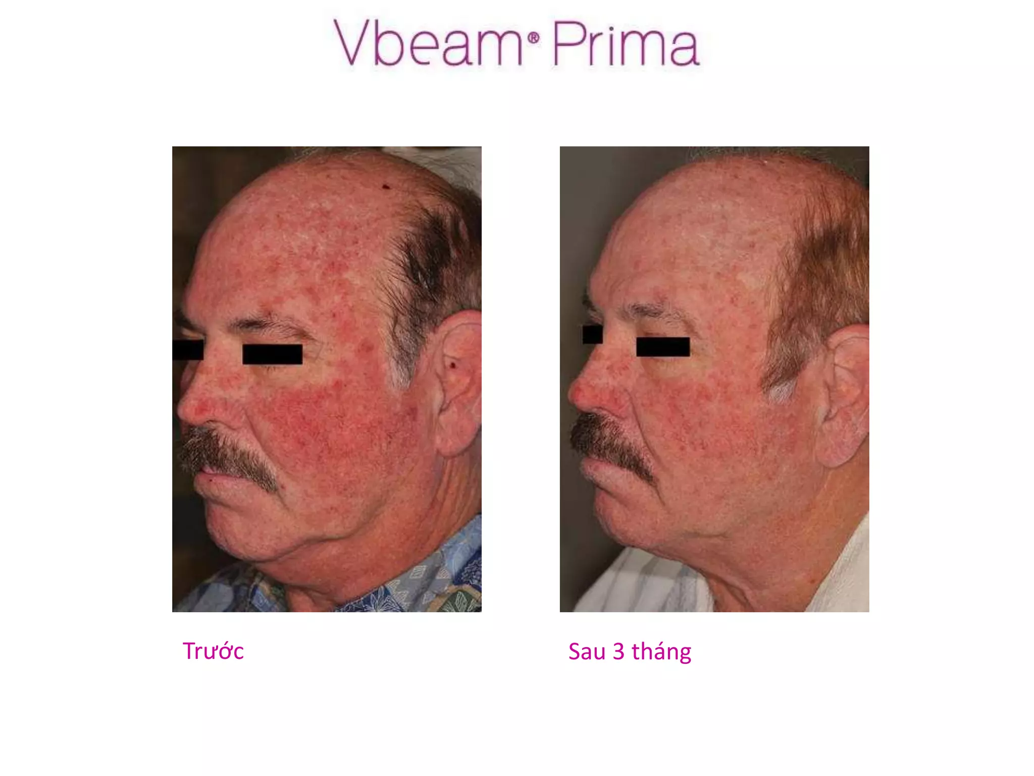 VBeam Prima NEW! Before and After treatment | PPTX