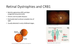 Retinal Dystrophies and CRB1 | PPTX