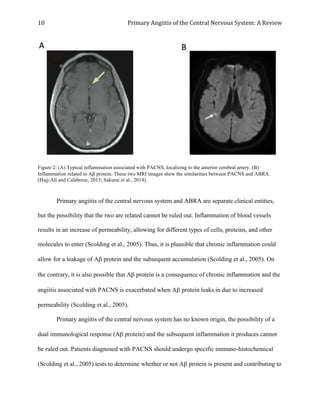 Diagnosis, Etiology, and Treatment of PACNS | PDF