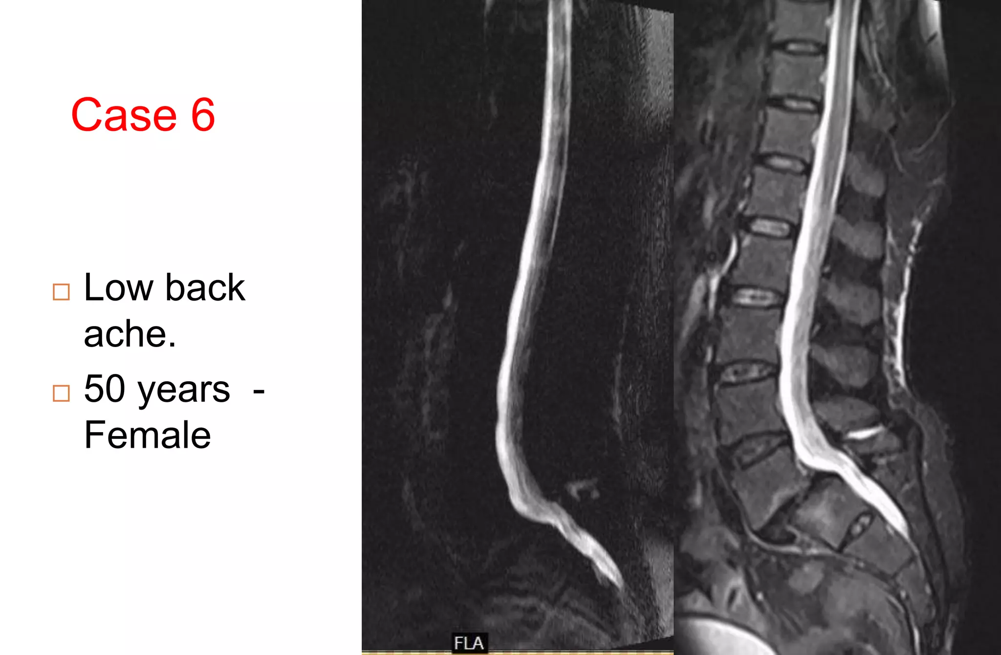 Baastrup’s Disease.pptx