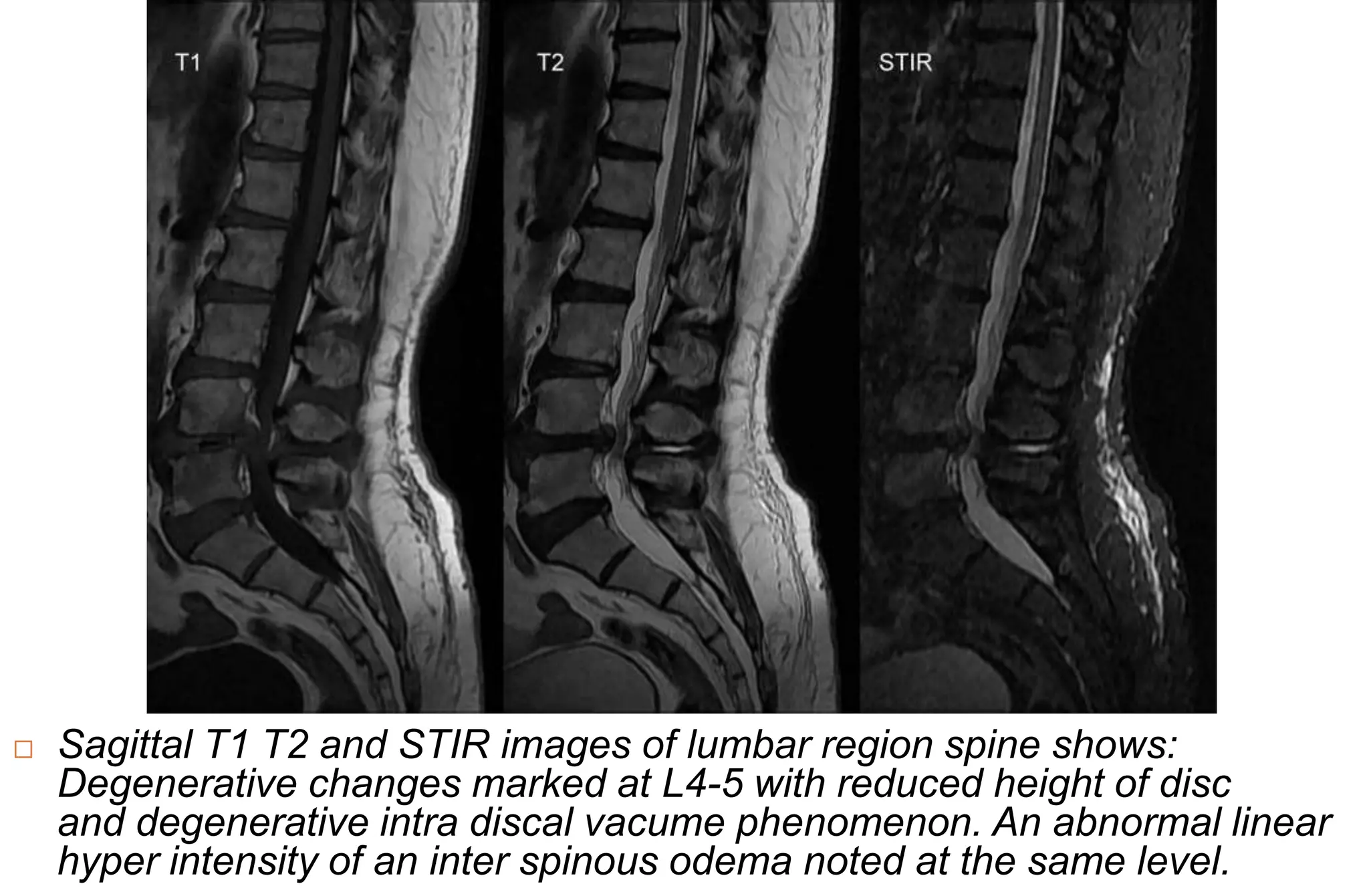 Baastrup’s Disease.pptx