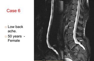 Baastrup’s Disease.pptx