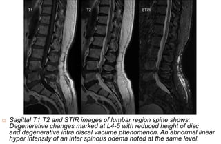 Baastrup’s Disease.pptx