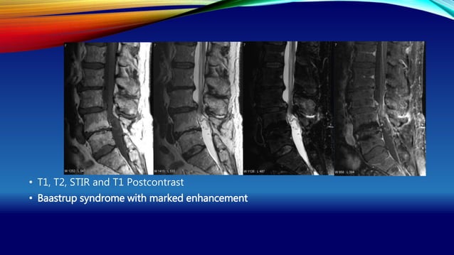 Baastrup syndrome Dr. Muhammad Bin Zulfiqar | PPTX
